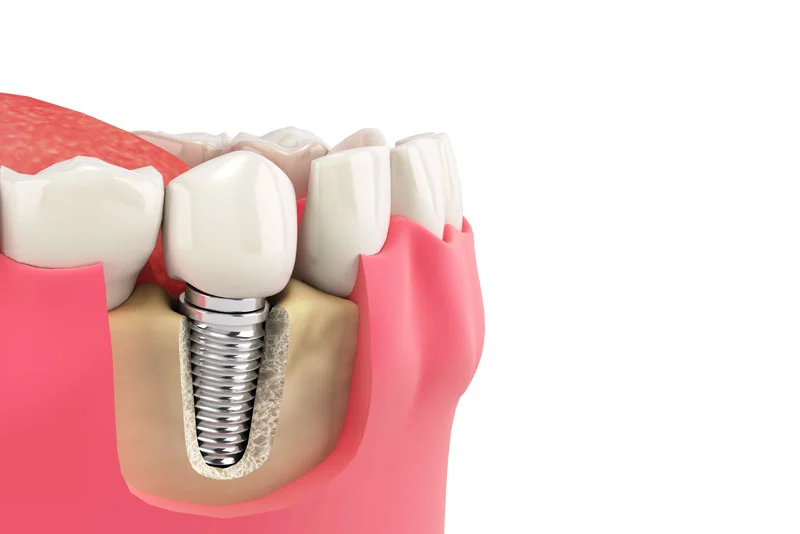 CHROME GuidedSMILE Implant Surgery | Imagine Your Smile in Woodbury MN