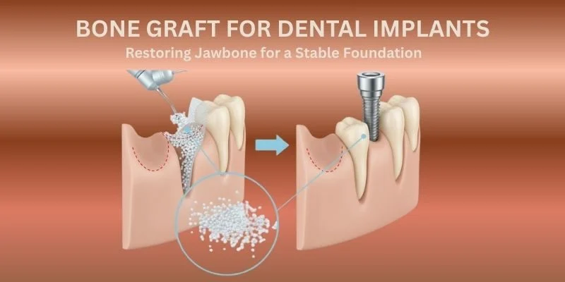 Bone Graft for Dental Implants: Benefits, Process & Cost