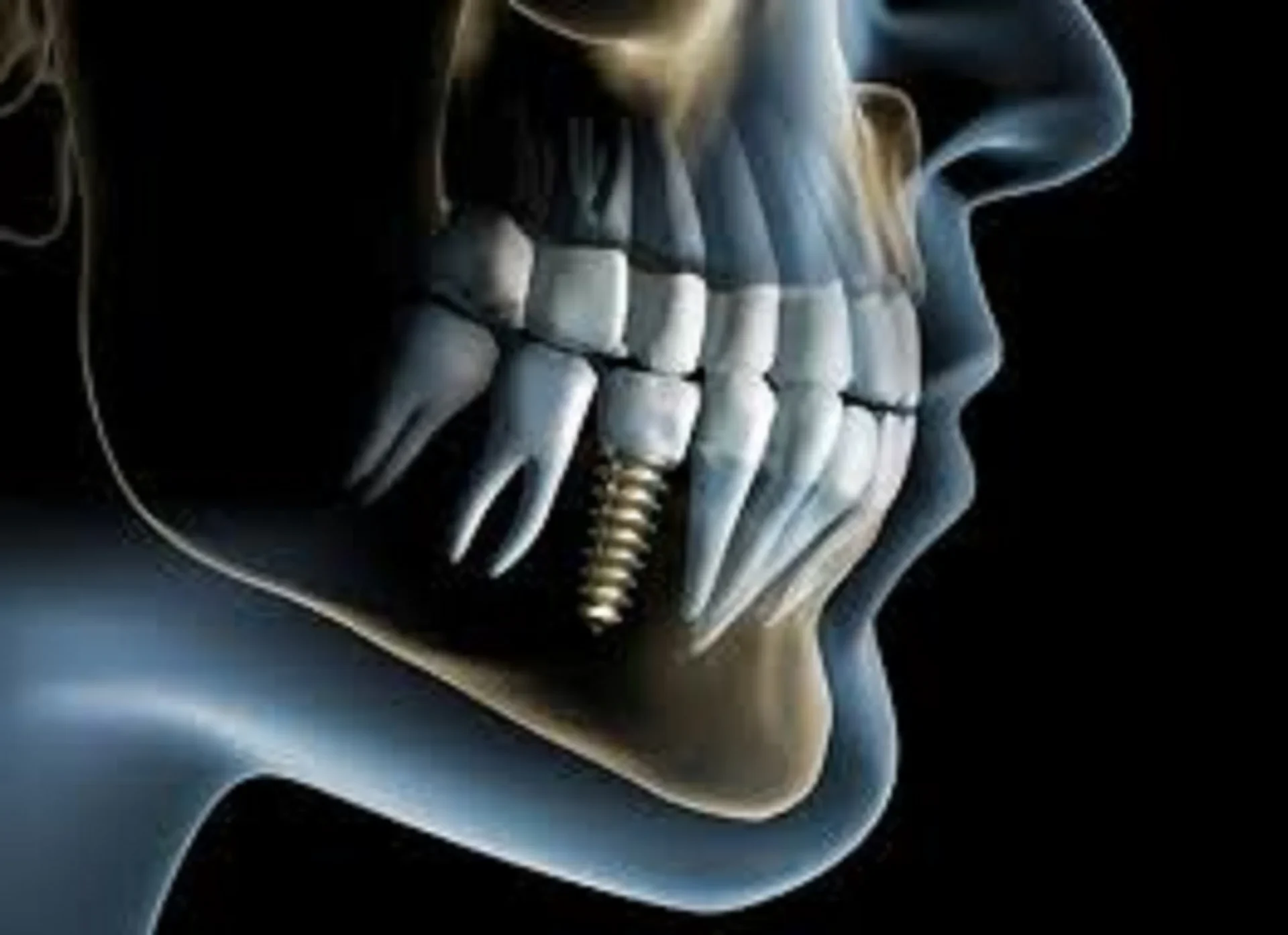 Replace Missing Teeth with Dental Implants in Woodbury MN | Imagine ...
